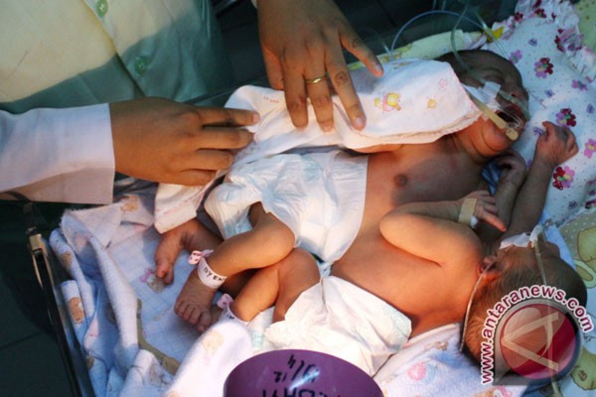 Bayi Kembar Siam Kediri - ANTARA News
