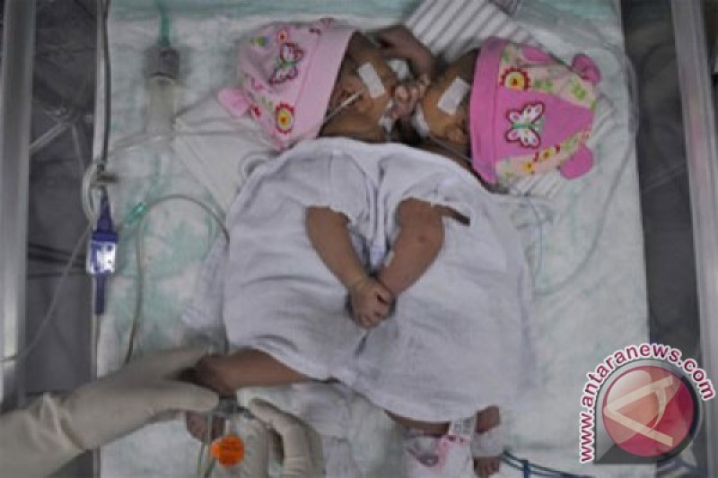 RS Hasan Sadikin rawat bayi kembar siam dempet kepala-perut - ANTARA News