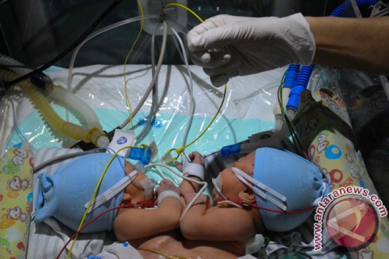 Salah satu bayi kembar siam meninggal - ANTARA News
